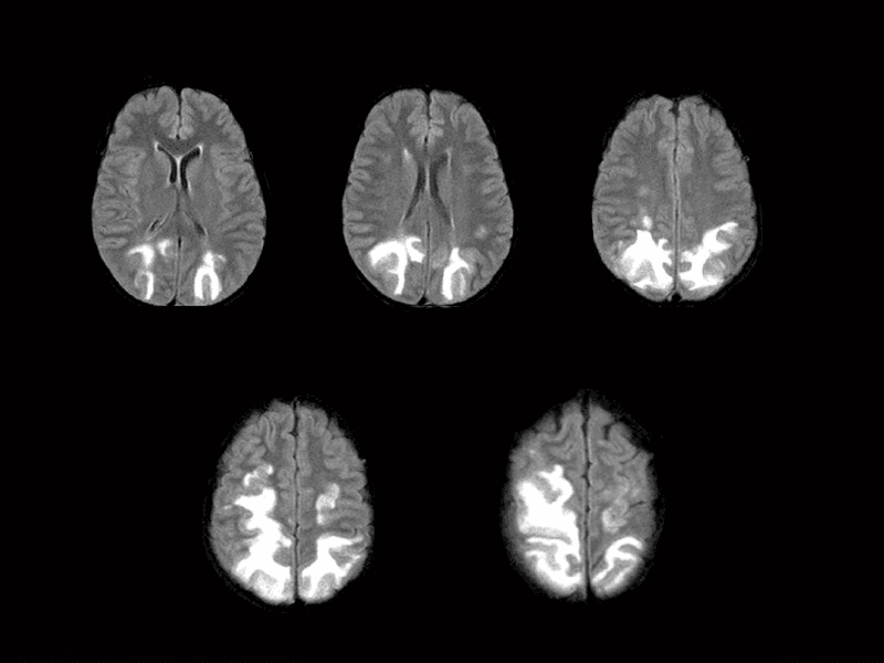 Caso Clínico: Agnosia visual en una mujer previamente sana