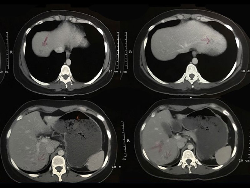 Caso Clínico: Multigesta añosa con astenia, adinamia y melena