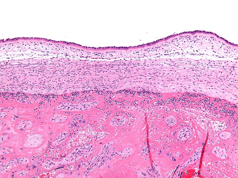 Nuevas recomendaciones para corioamnionitis durante el parto