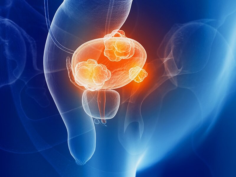 Se describe el cáncer vesical de "muy bajo riesgo"