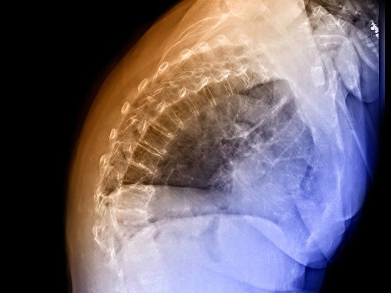 ¿Es mejor tratar la pérdida ósea causada por corticosteroide con denosumab?