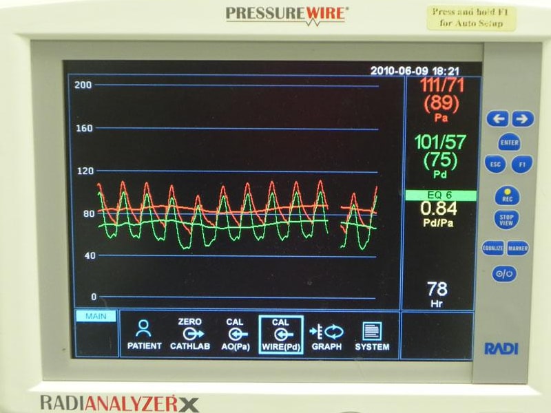 Medición de la reserva fraccional de flujo coronario