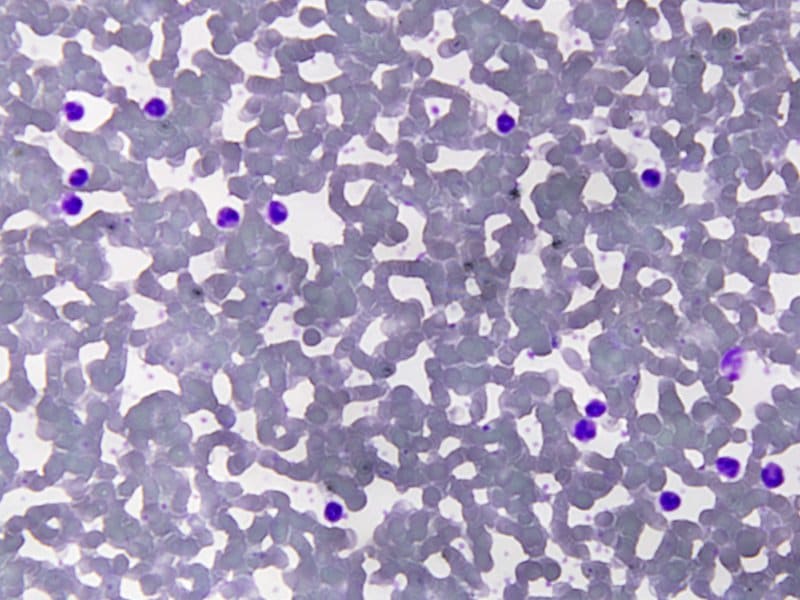 Mini Examen Clínico: ¿Conoce las características de la policitemia vera ...