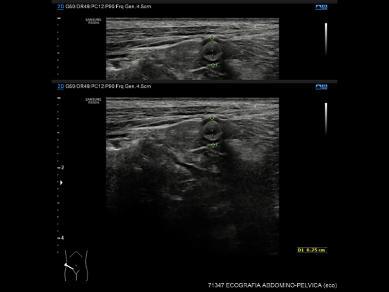 Caso Clínico: Dolor abdominal recurrente: ¿Patología quirúrgica ...