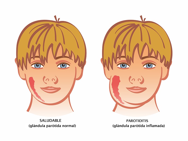 Sin riesgo de epidemia ante aumento de casos de parotiditis en México