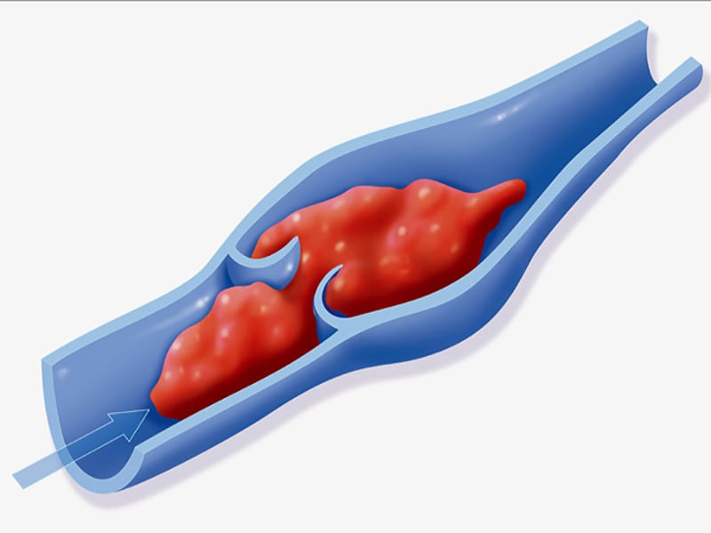 Nueva guía de la American Society of Hematology para tromboembolia venosa