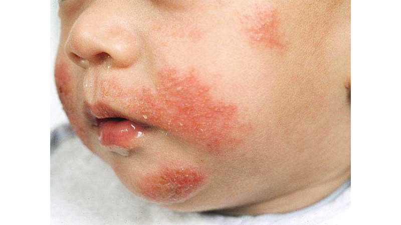 Diagnóstico y tratamiento de dermatitis atópica secundariamente infectada