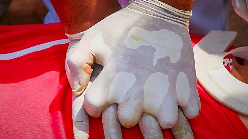 Frecuencia y profundidad óptimas de compresiones en reanimación ...