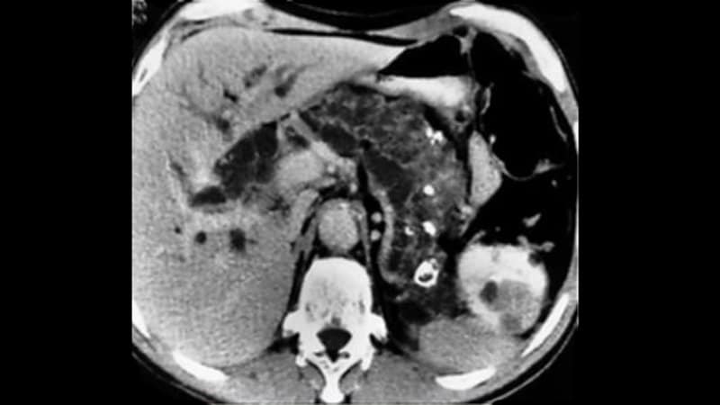 Caso Clínico: Paciente femenino de 15 años con esteatorrea y nictalopía