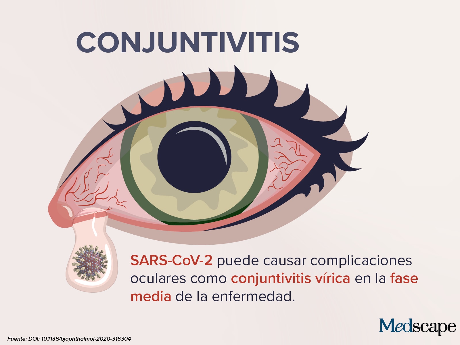 Tendencia Clínica: Conjuntivitis
