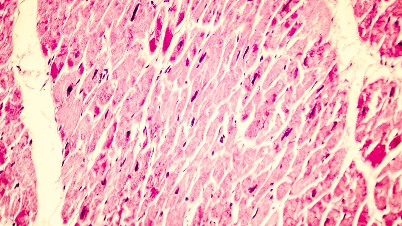 Pronóstico de la hipertrofia ventricular antes y después de reemplazo ...