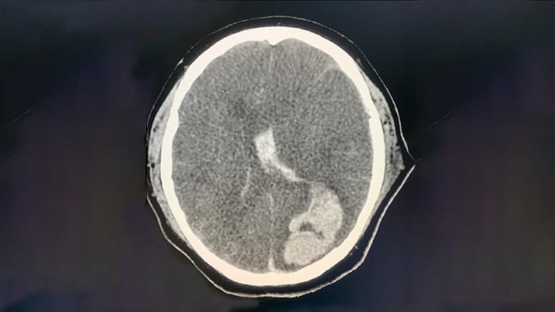 Caso clínico: Coma relacionado con COVID-19