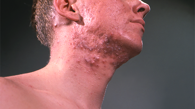 Acné: influencia de la dieta en nuestra piel