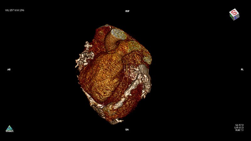 Imagen cardiaca en pericarditis constrictiva: desde fisiopatología ...