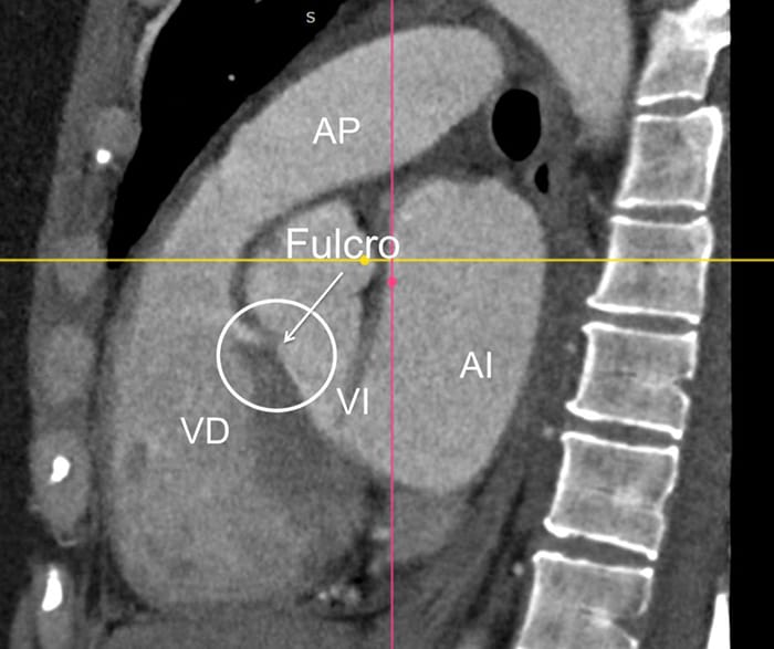 El fulcro puede revolucionar la mecánica y morfología cardiacas