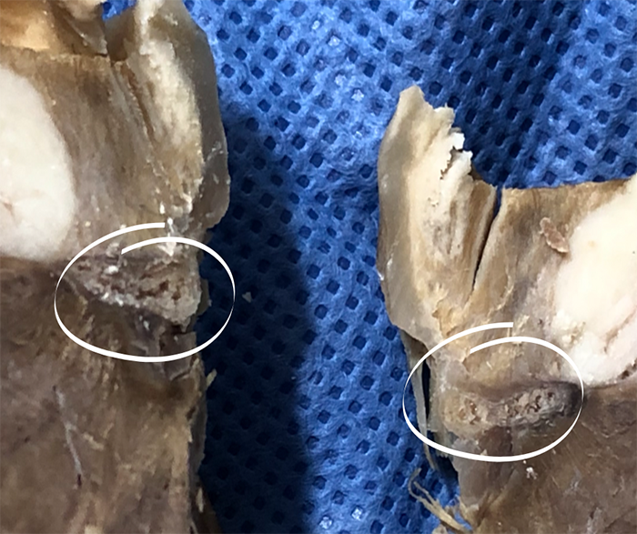 El fulcro puede revolucionar la mecánica y morfología cardiacas