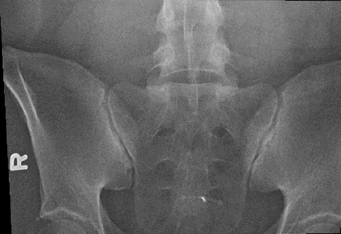Radiografía De La Articulación Sacroilíaca Normal
