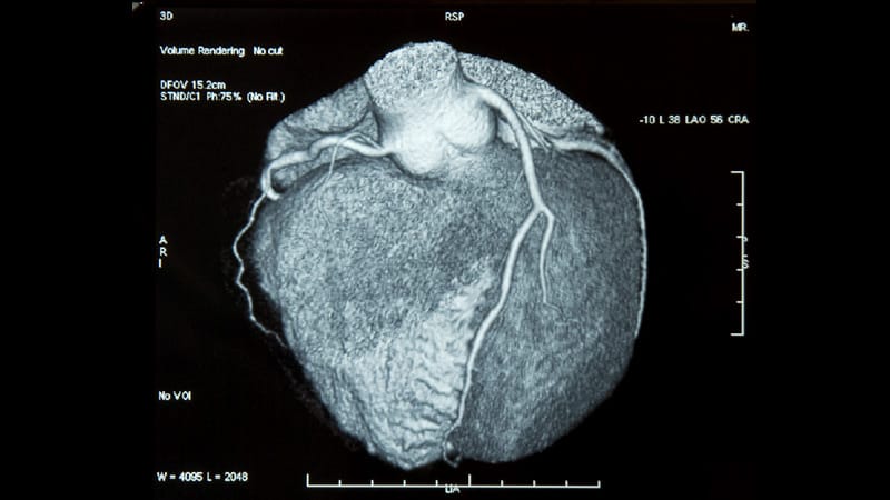La tomografía coronaria acecha a la angiografía coronaria diagnóstica