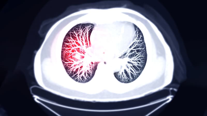 Manejo de la tromboembolia pulmonar en pacientes con enfermedades ...