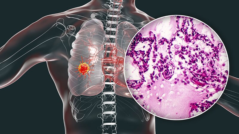 La depresión se relaciona con la sobrevida en el cáncer de pulmón