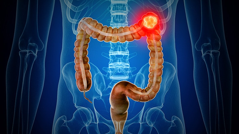 ¿Por qué está aumentando el cáncer colorrectal en los jóvenes?