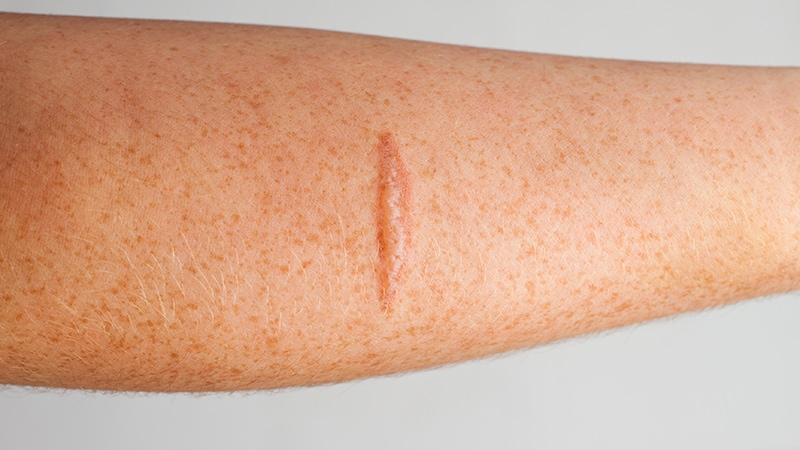 Cuando se tratan cicatrices, el objetivo es la "rehabilitación"