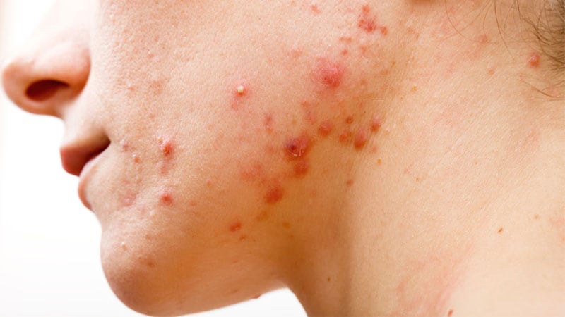 Tratamiento del acné en Latinoamérica, recomendaciones de un consenso