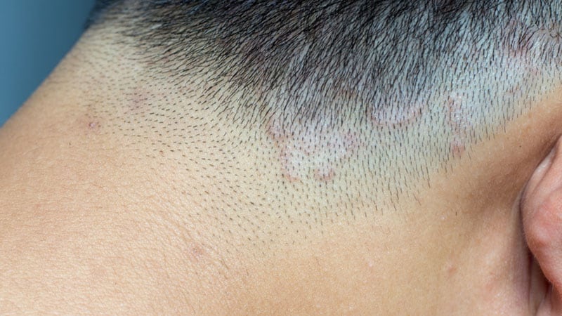 «Trichophyton tonsurans»: patógeno emergente en tiñas del cuero ...