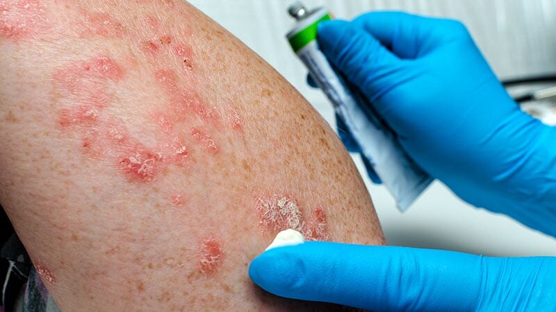 Expertos definen la remisión durante tratamiento en la psoriasis en placas