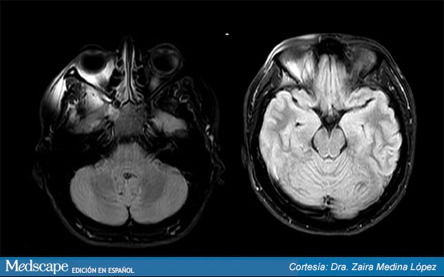 Haciendo sinapsis: Mi paciente tiene vértigo intratable: ¿cómo la abordo?