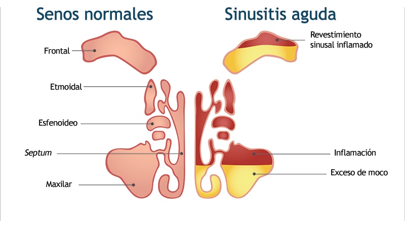 Tratamiento de la sinusitis aguda