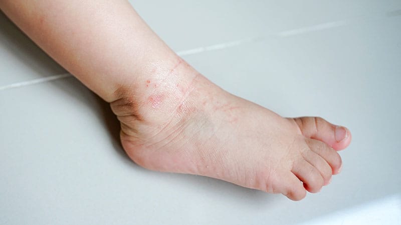Fenotipos de dermatitis atópica asociada a la edad evaluados en un ...