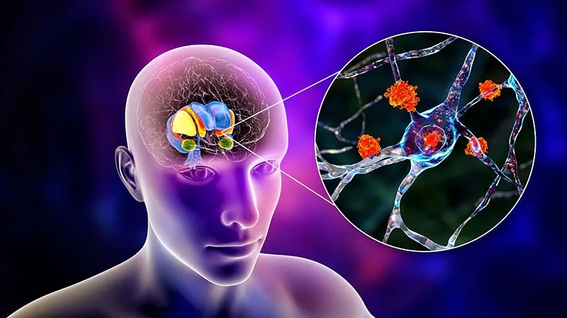 Enfermedad de Huntington: 5 datos que hay que saber