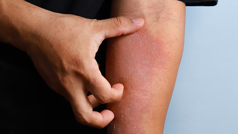 Lebrikizumab y nemolizumab: dos nuevos fármacos para dermatitis atópica