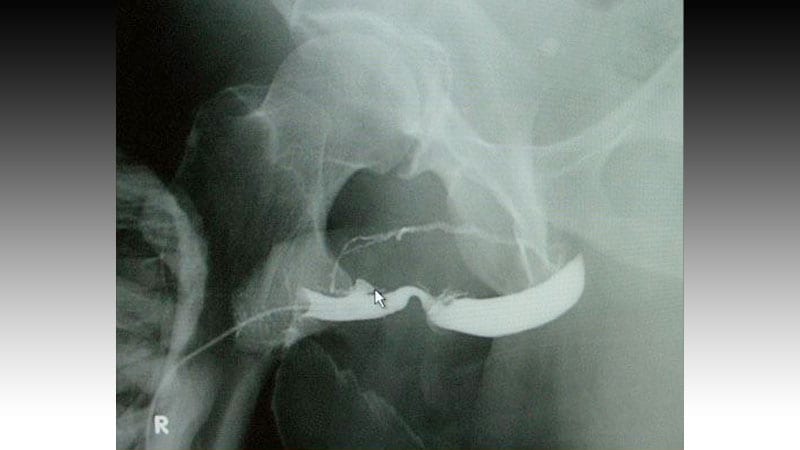 Caso clínico: Lesión en el pene tras una caída - Page 4