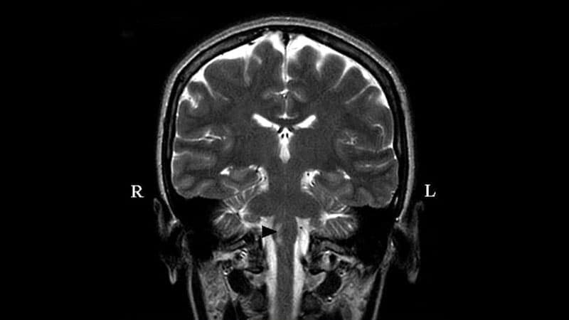 Sindrome De Wallenberg Ressonancia Magnetica Síndrome De Horner: