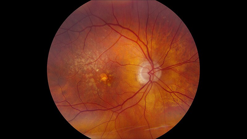 Taurina, ¿un nutracéutico para prevenir la degeneración de la retina?