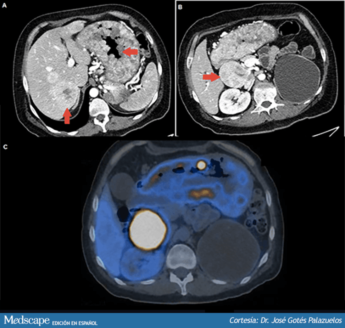 5-minutos-de-endocrinolog-a-paciente-masculino-con-dolor-abdominal-y