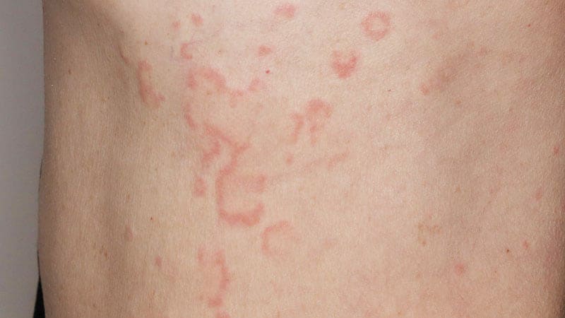 Caso clínico: Paciente femenina con erupción cutánea pruriginosa e insomnio