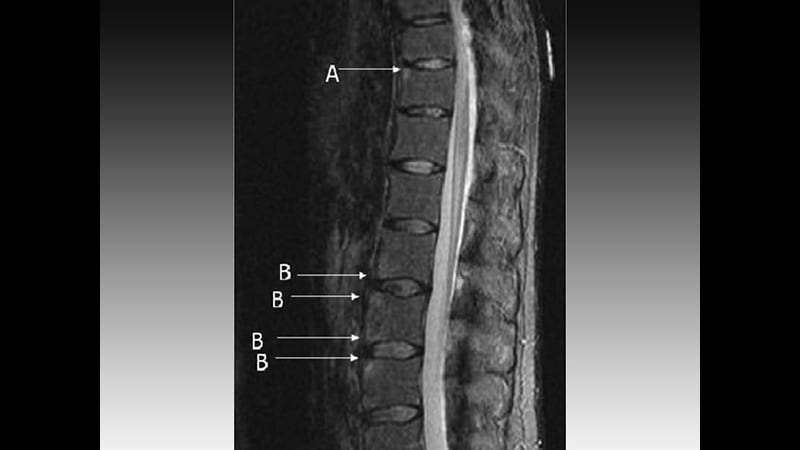 Los hallazgos radiográficos de espondiloartritis son altamente ...