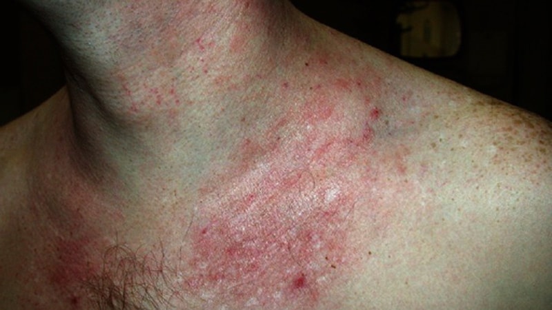 Mayor riesgo de enfermedad inflamatoria intestinal con dermatitis atópica