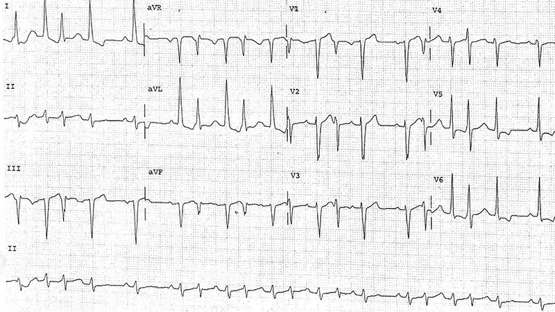 ECG: Hiperlipidemia y pulso irregular