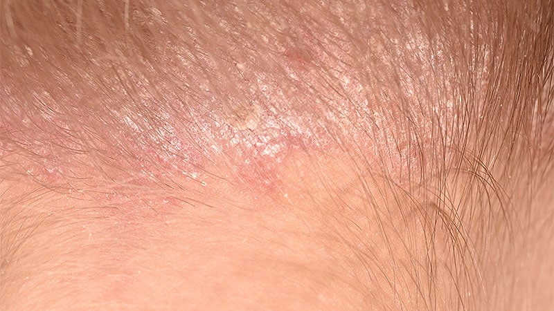 Mini-examen clínico: Abordaje global de la psoriasis del cuero cabelludo