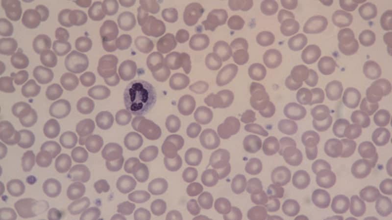 Mini-examen clínico: Tratamiento de la anemia ferropénica - Page 5