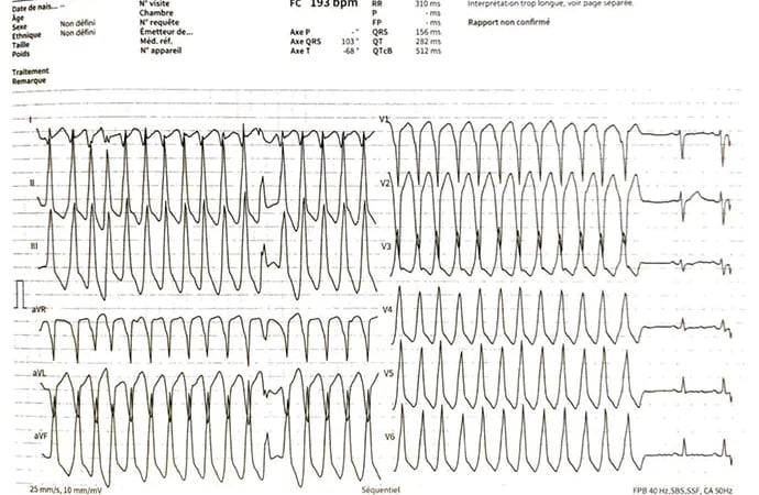 ECG: Palpitaciones y disnea en paciente de 45 años