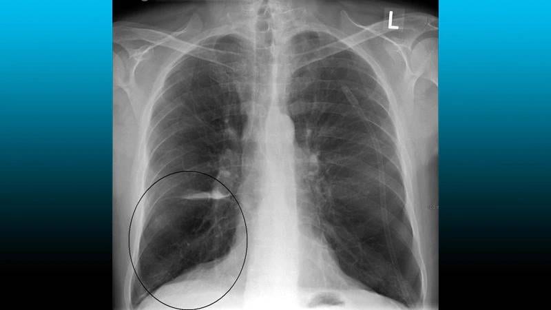 ¿Es el sueño clave en las exacerbaciones de la enfermedad pulmonar ...