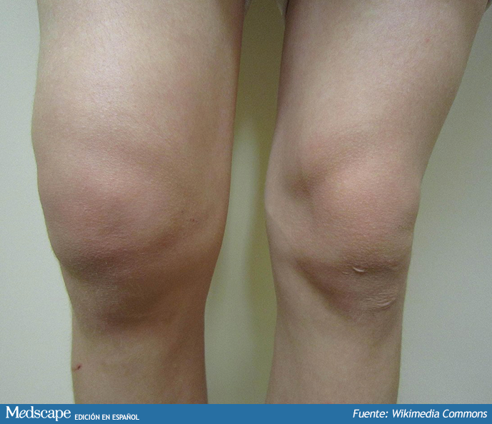Caso clínico: Agricultor con dolor, rubor y calor en la rodilla derecha ...