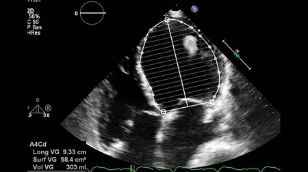 Masse attachée à la paroi ventriculaire gauche