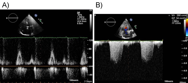 Cas clinique : dyspnée chez un patient avec de multiples comorbodités