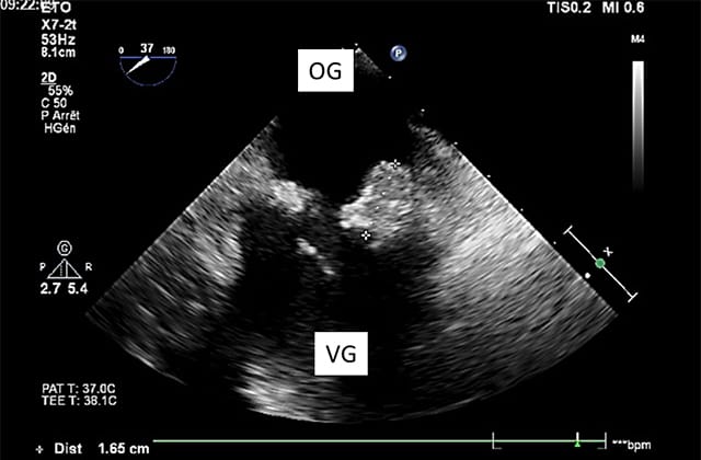 Cas clinique : Quel est votre diagnostic associé au rétrécissement mitral